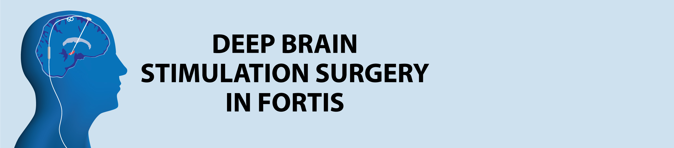 CO - International - Deep Brain Stimulation Parkinson's | Fortis Healthcare