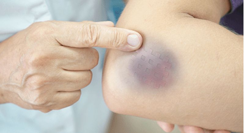 Exploring Purpura: Symptoms, Causes, and Treatment Options