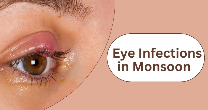 Common Monsoon Eye Infections and How to Prevent Them | Fortis Healthcare