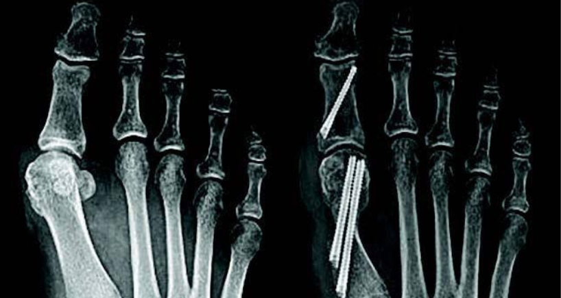 Bunion Correction Surgery: Why Early Treatment at Fortis Hospital ...