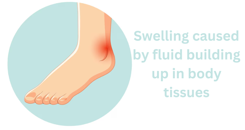 Understanding Edema in Elderly: Signs, Causes & Treatment