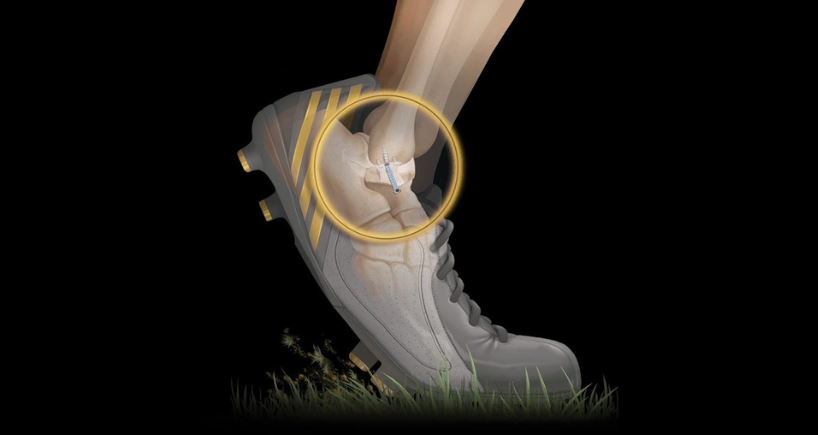 Ankle Ligament Injury & Recovery: Benefits of Internal Brace Technology