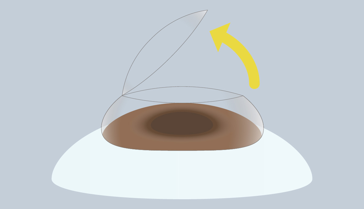 Breast reconstruction with flap surgery