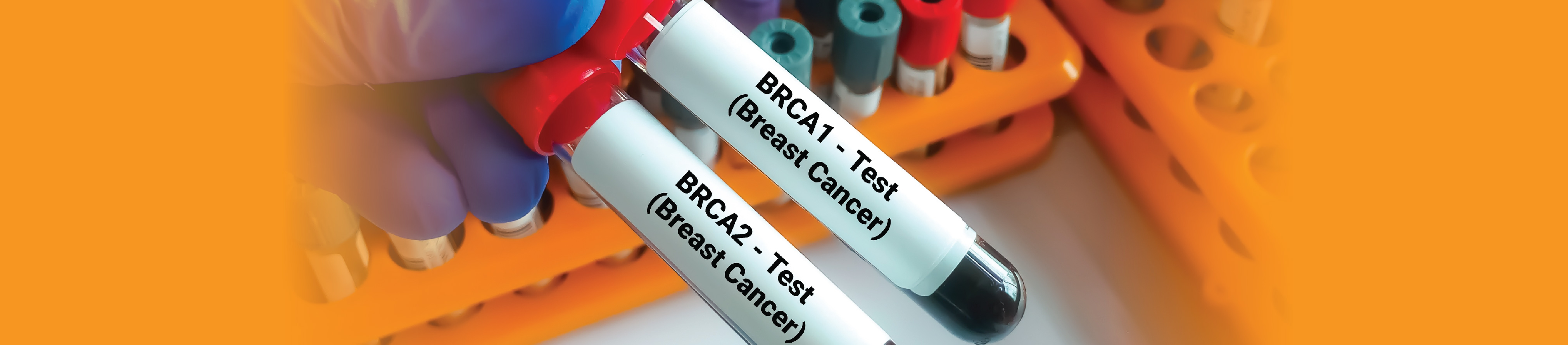 BRCA gene test for breast cancer | Fortis Healthcare