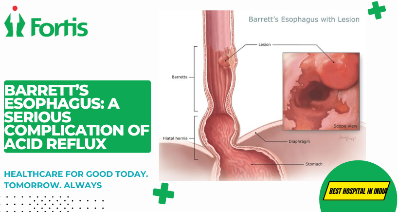 Barrett’s Esophagus: Acid Reflux Complication Explained