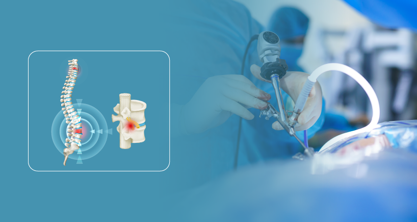Minimally Invasive Spine Surgery: Is Keyhole Surgery Right for You ...