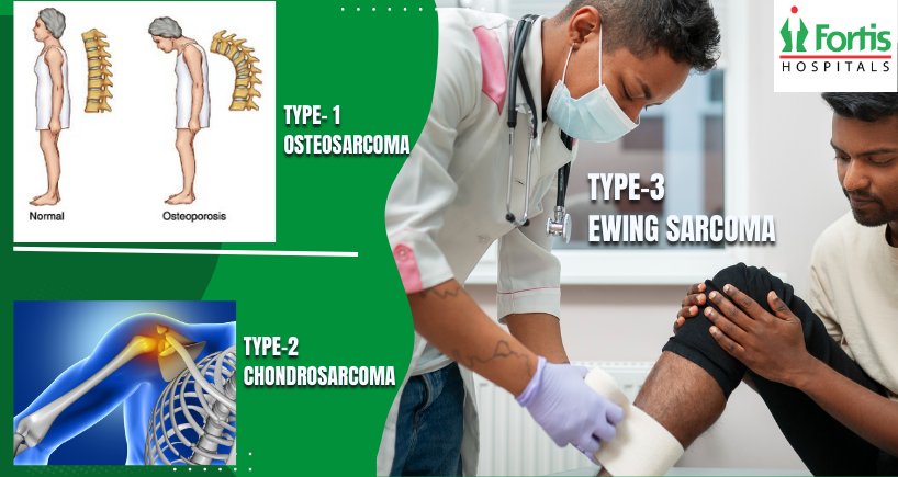 Types of Ewing Sarcoma: A Simple Guide